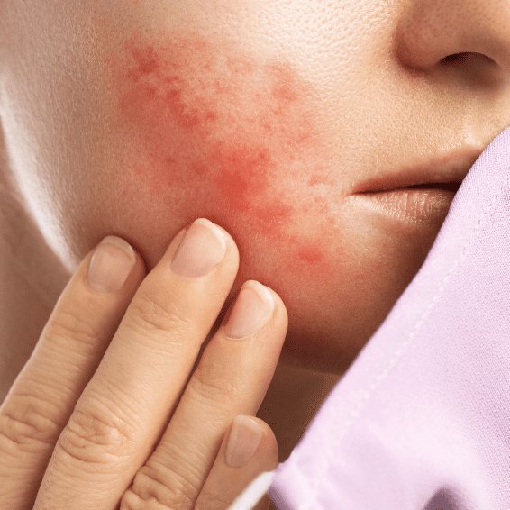 Acne Skin – MeStore